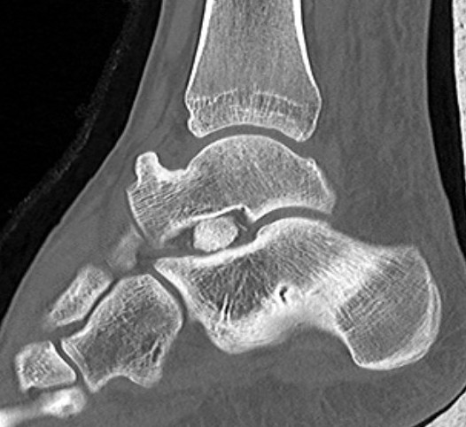 Subtalar Dislocation | The Bone School